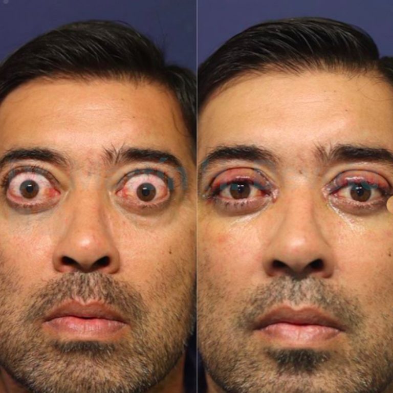 Enfermedad de tiroides y ojos
